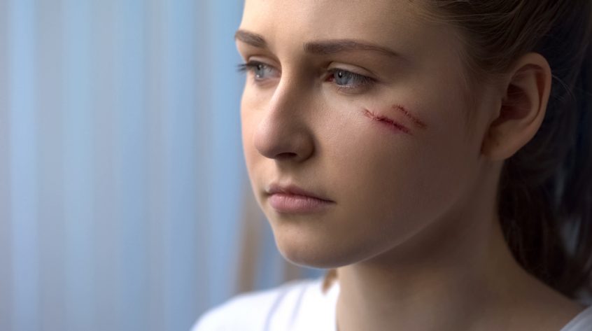 Face of young depressed woman with scars on cheek, trauma after car ...